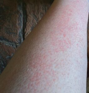 What is Disney Rash? A Look At Exercise-Induced Vasculitis